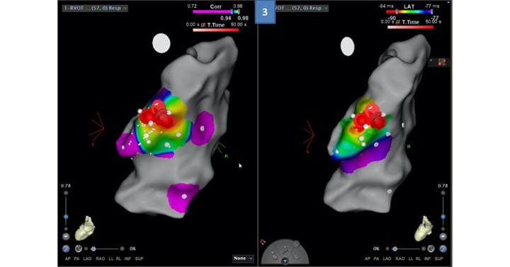 驛動的心跳 林中行醫師 Chung-Hsing Lin, MD: 心室期外收縮VPC是什麼?