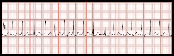 Practice EKG Rhythm Strips 196