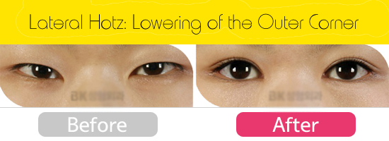 Eyelid Surgery Legend Dr. Kim Byung Gun: [BK Plastic Surgery Hospital ...