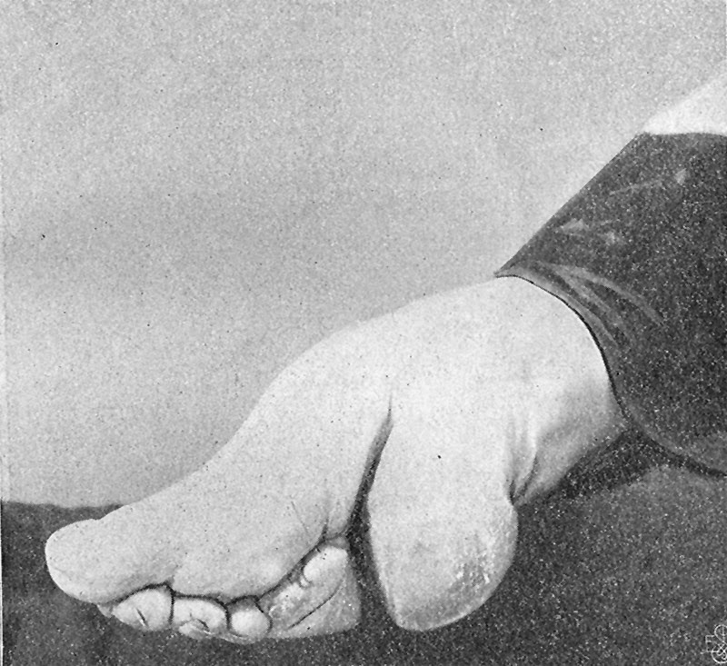 Foot Binding Children