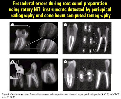 PDF: Procedural errors during root canal preparation using rotary NiTi ...