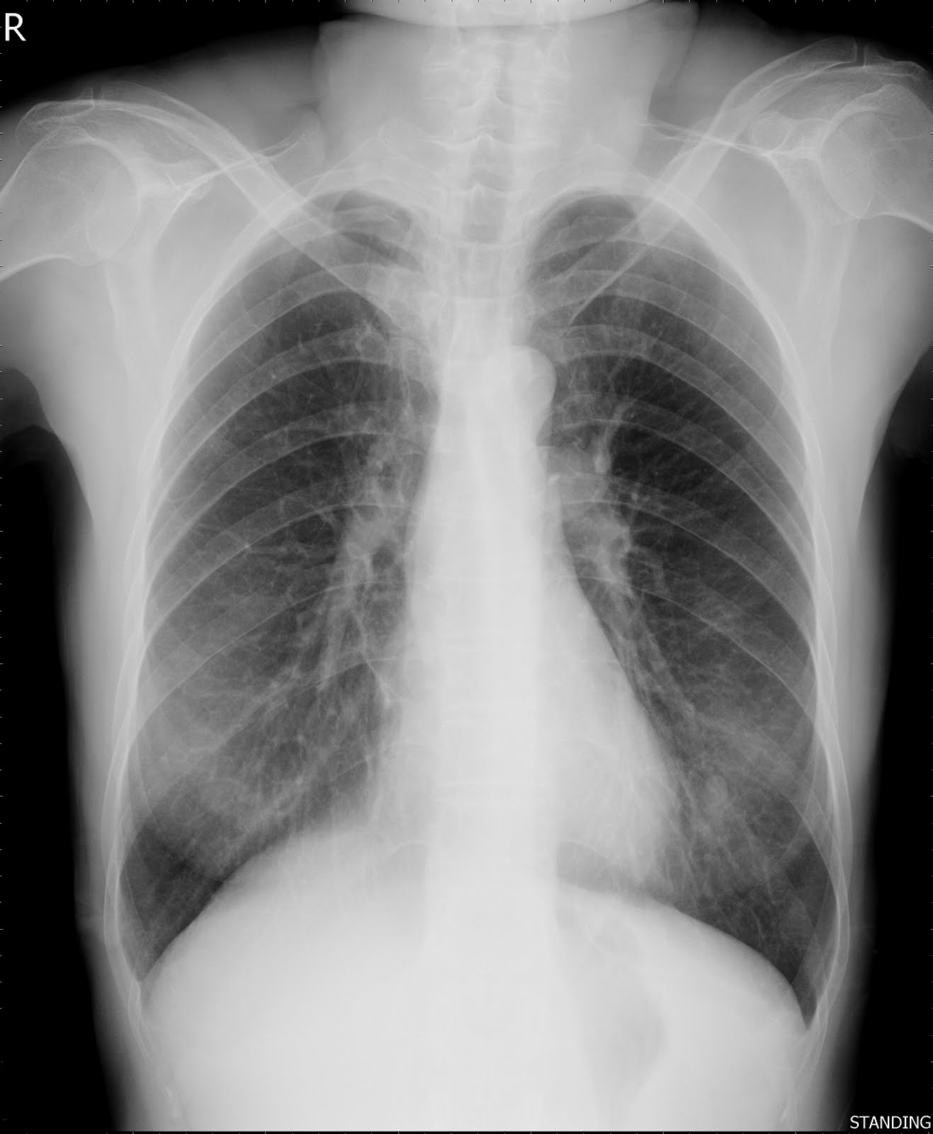 CXR 胸部x光判讀 lung mass part-3