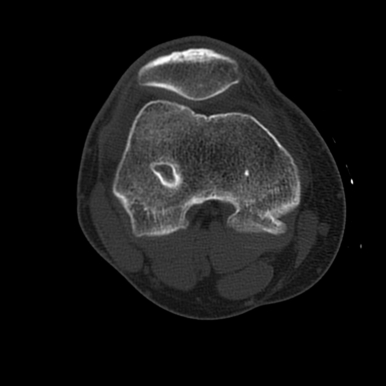 CT Knee - Radiology Imaging