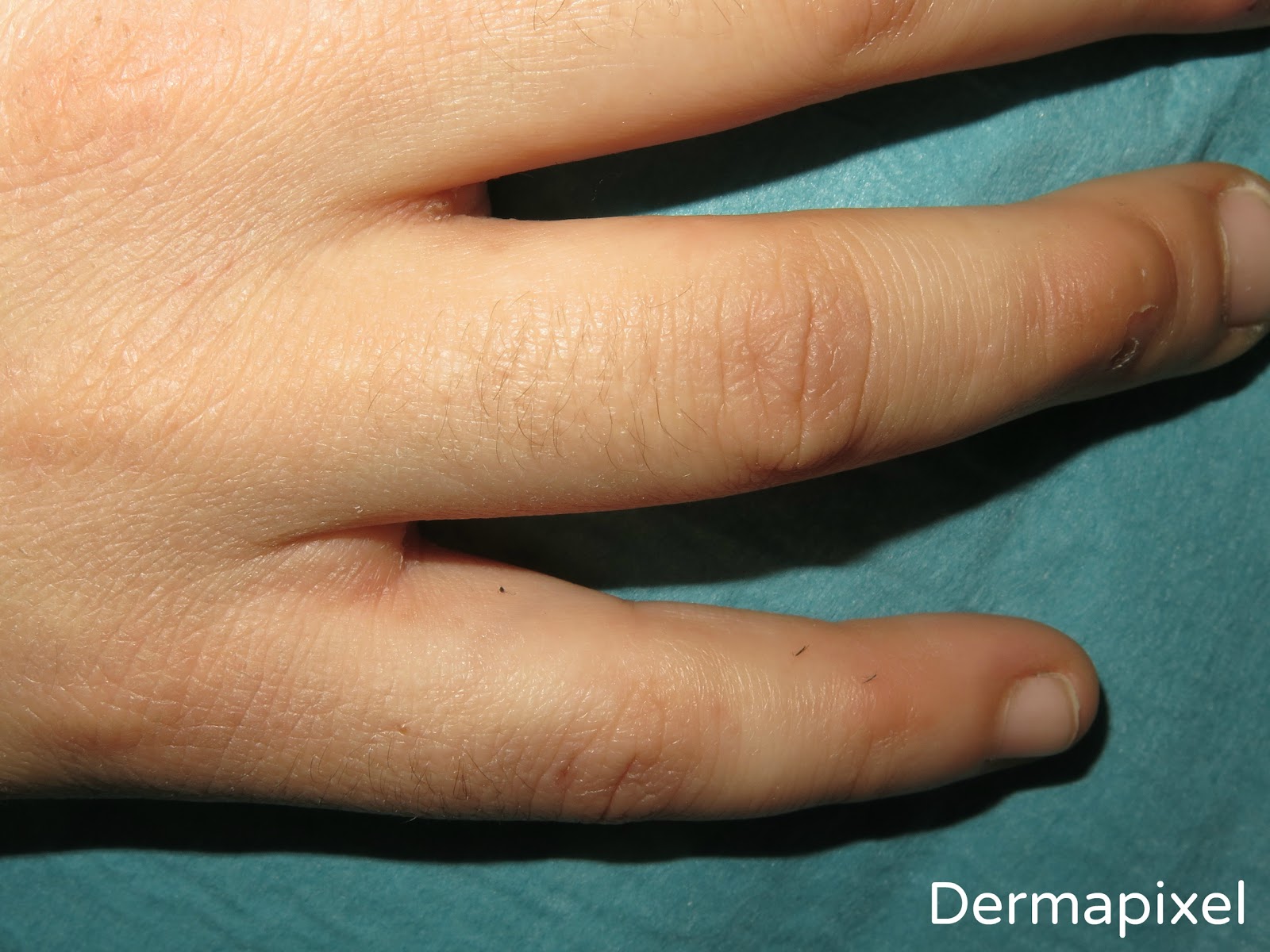 Dermapixel: junio 2017