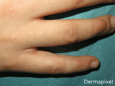 Dermapixel: junio 2017