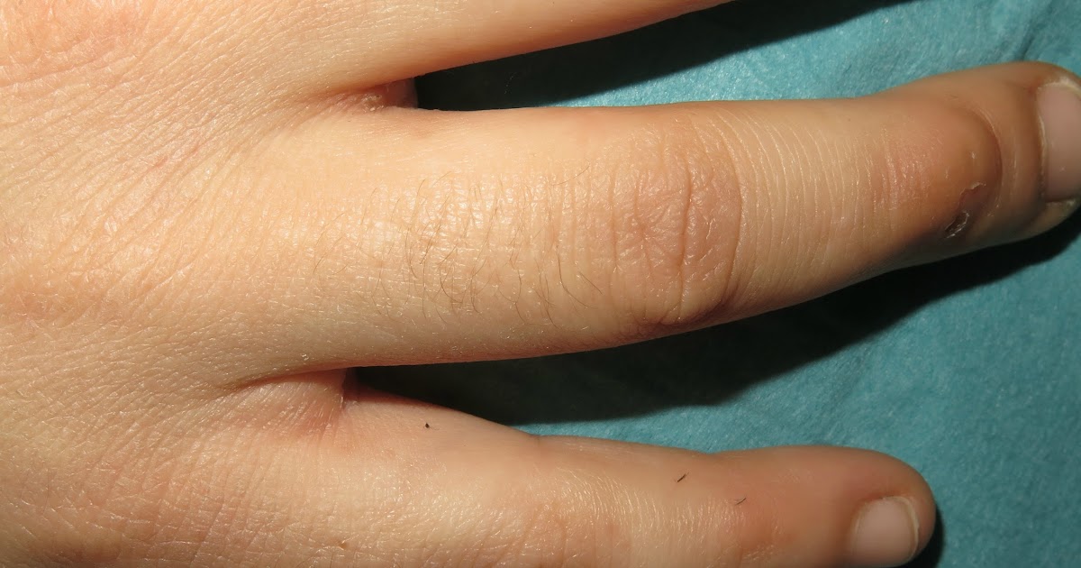 Dermapixel: Sinus pilonidal interdigital como enfermedad profesional