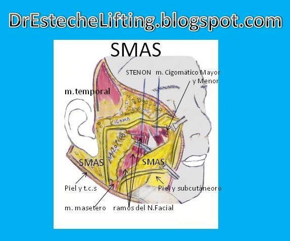 Dr.Esteche | Cirugía Plástica Facial | Cirugía Facial: 7 ."FACE LIFT ...