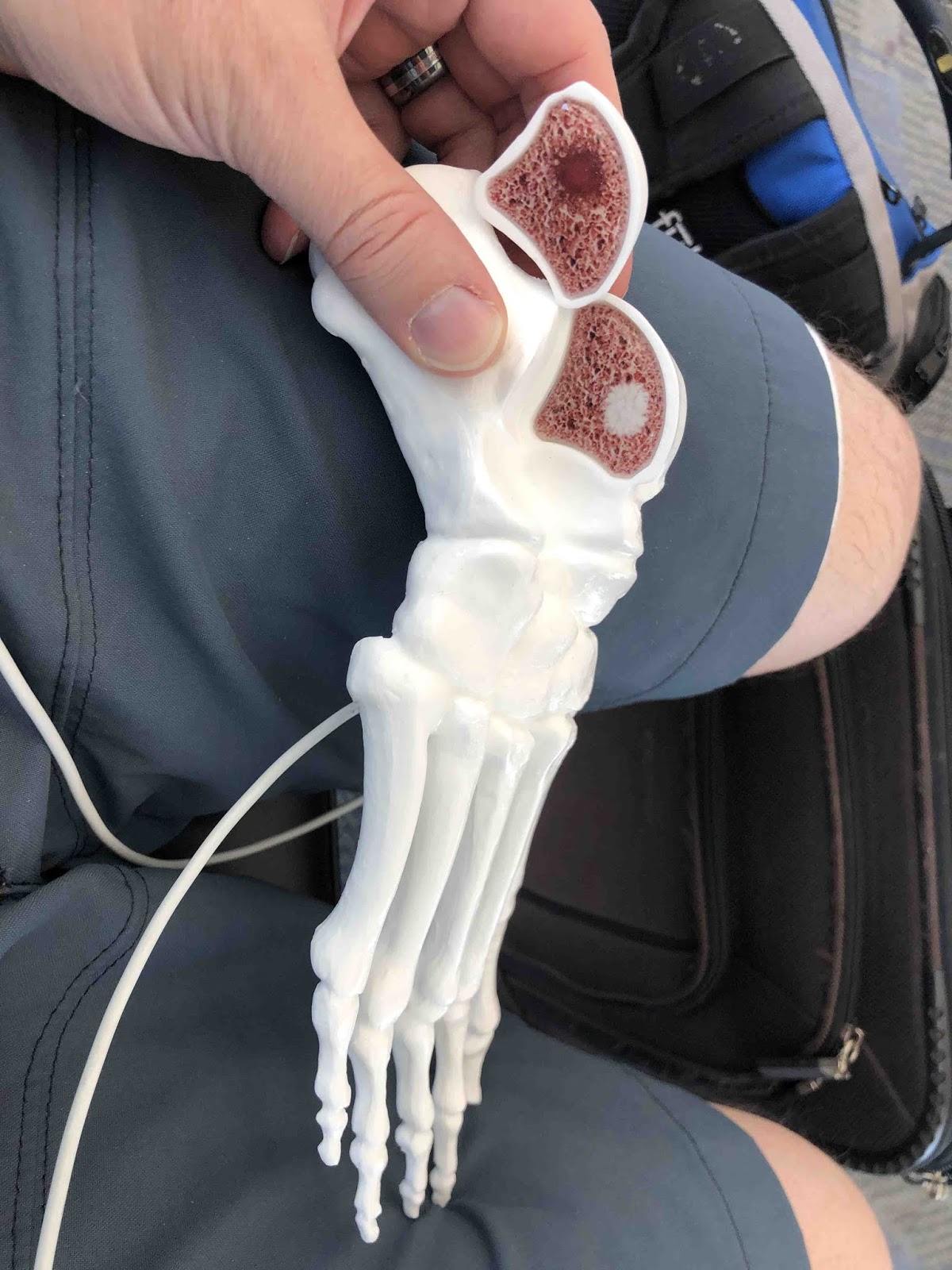 Advances in Surgical Technology: Injectable Bone Substitute