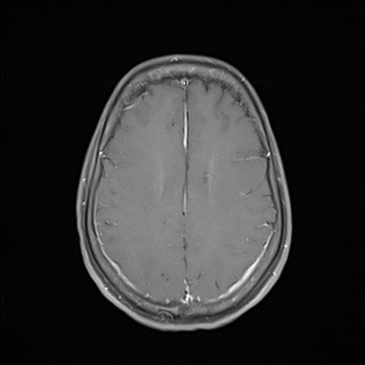 Ultimate Radiology : Hypertrophic Pachymeningitis