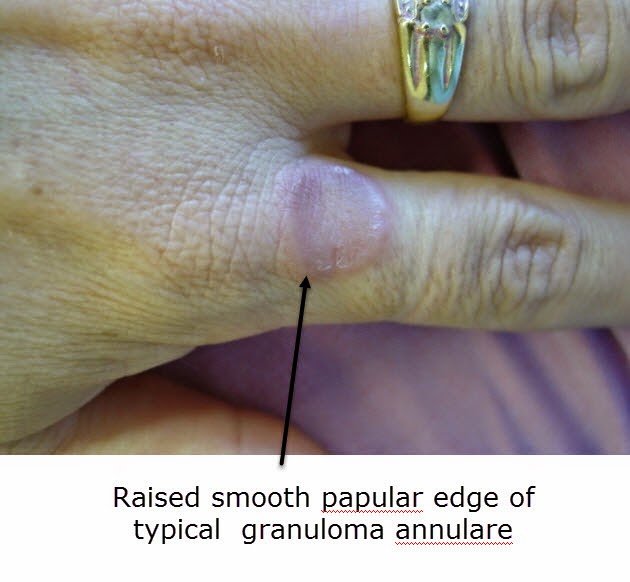 Dermatopathology Made Simple - Inflammatory: Granulomatous Reaction Pattern