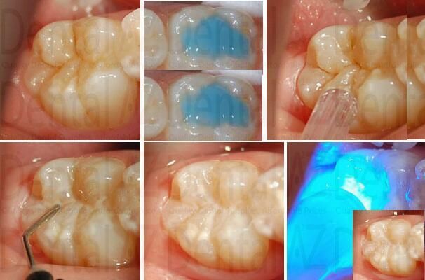 FAMILY CARE DENTAL: FISSURE SEALANTS