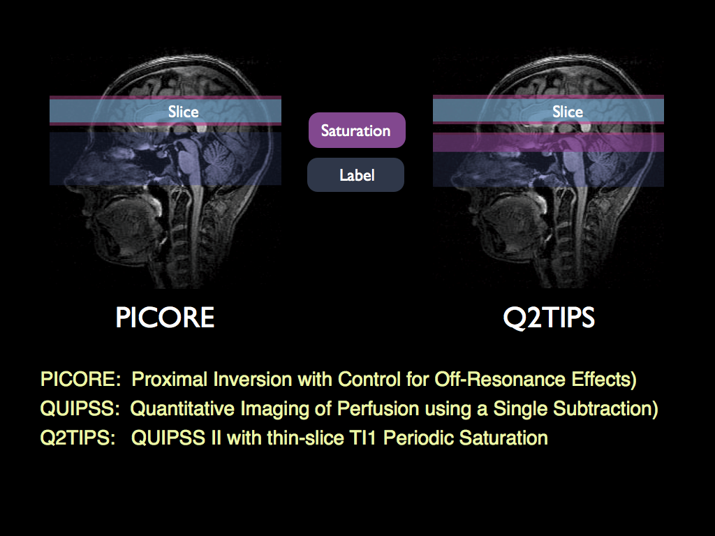MRI BLOG: Arterial Spin Labeling (ASL)
