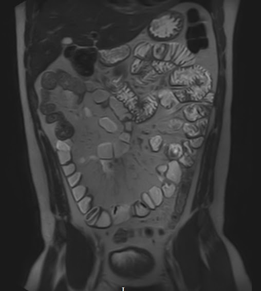 MR Enterography : Crohn's Disease - Sumer's Radiology Blog