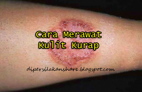Petua Terbaik Merawat Penyakit Kurap ~ Baca Disini