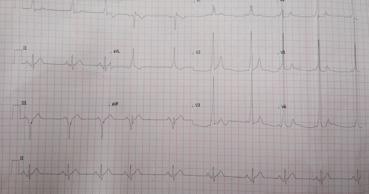 Cardiology window: WPW syndrome, left posterior pathway, intermittent ...