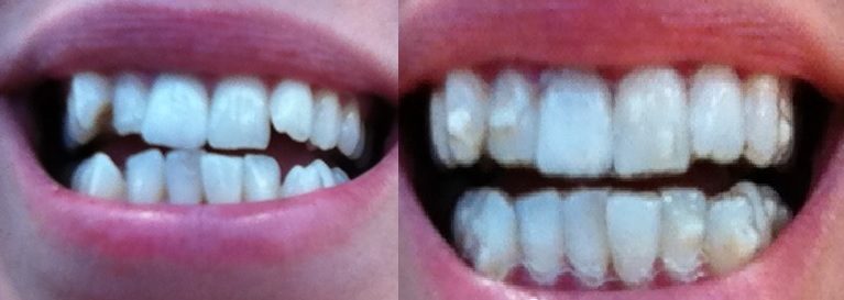 Michelle's Invisalign Journey: Trays 11 & 12