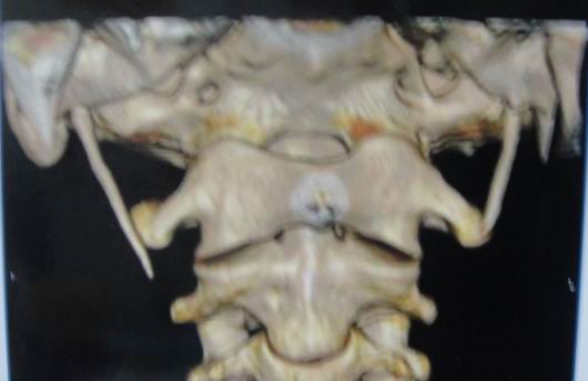 VIETNAMESE MEDIC ULTRASOUND: CASE 127: ELONGATED STYLOID PROCESS, Dr ...