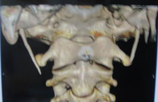 VIETNAMESE MEDIC ULTRASOUND: CASE 127: ELONGATED STYLOID PROCESS, Dr ...