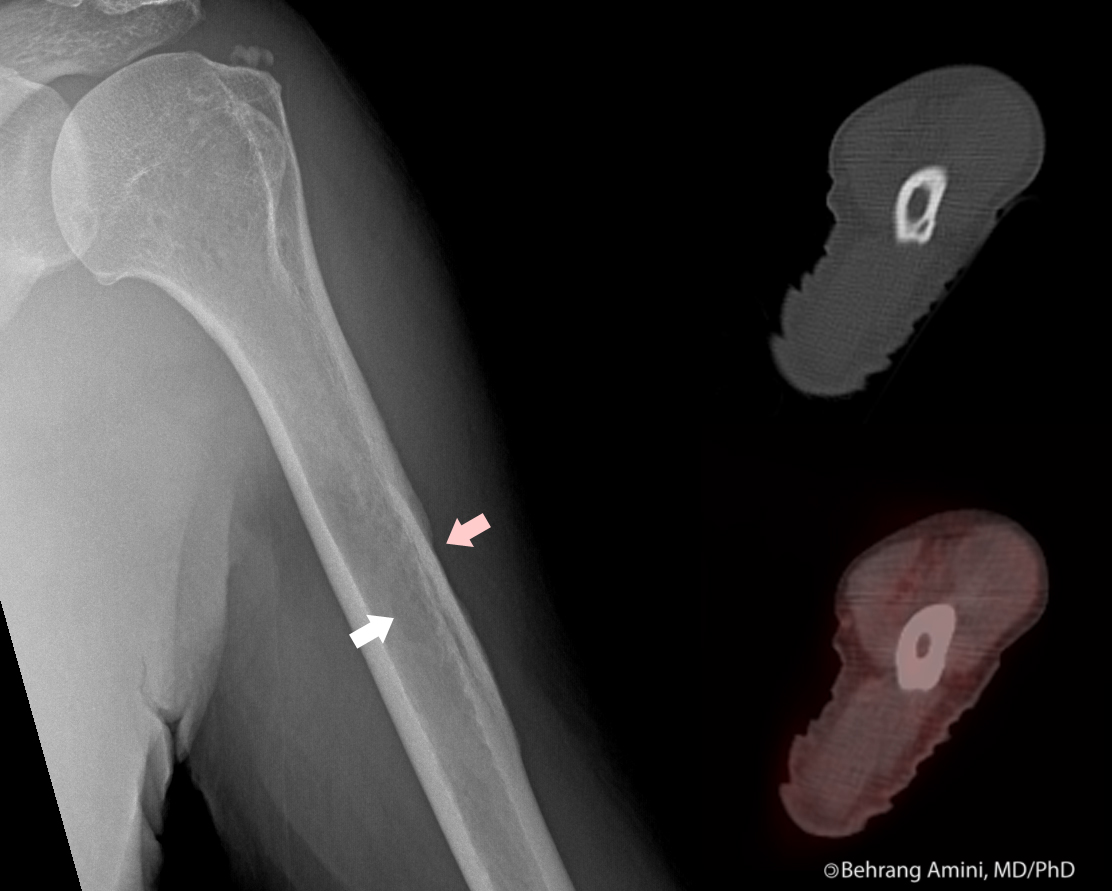 Is Periosteal Reaction Normal at Pamela Walsh blog