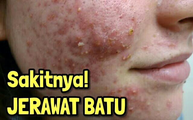 Cara Menghilangkan Jerawat Batu hinggap di Muka dengan Berkesan dan ...