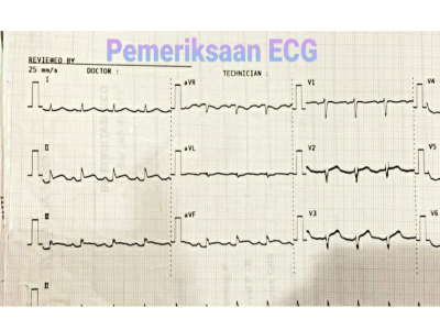 Pengertian dan Tujuan Pemeriksaan EKG Dalam Ilmu Kedokteran | Portal ...