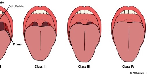 Modified Mallampati Classification