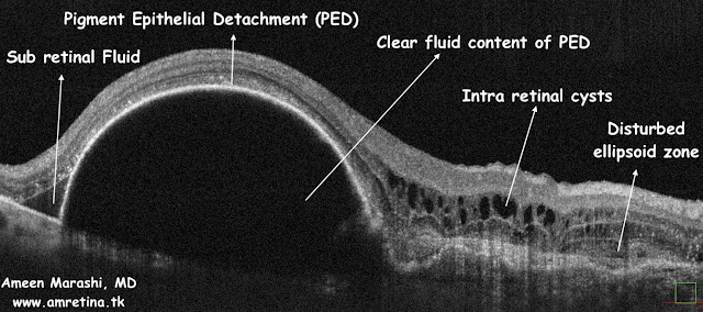 Approaching serous PED