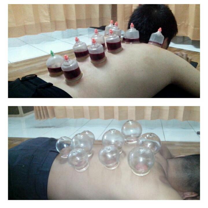 GRIYA SEHAT ALBIRUNI: BEDA SINDROM, BEDA TEKNIK BEKAMNYA