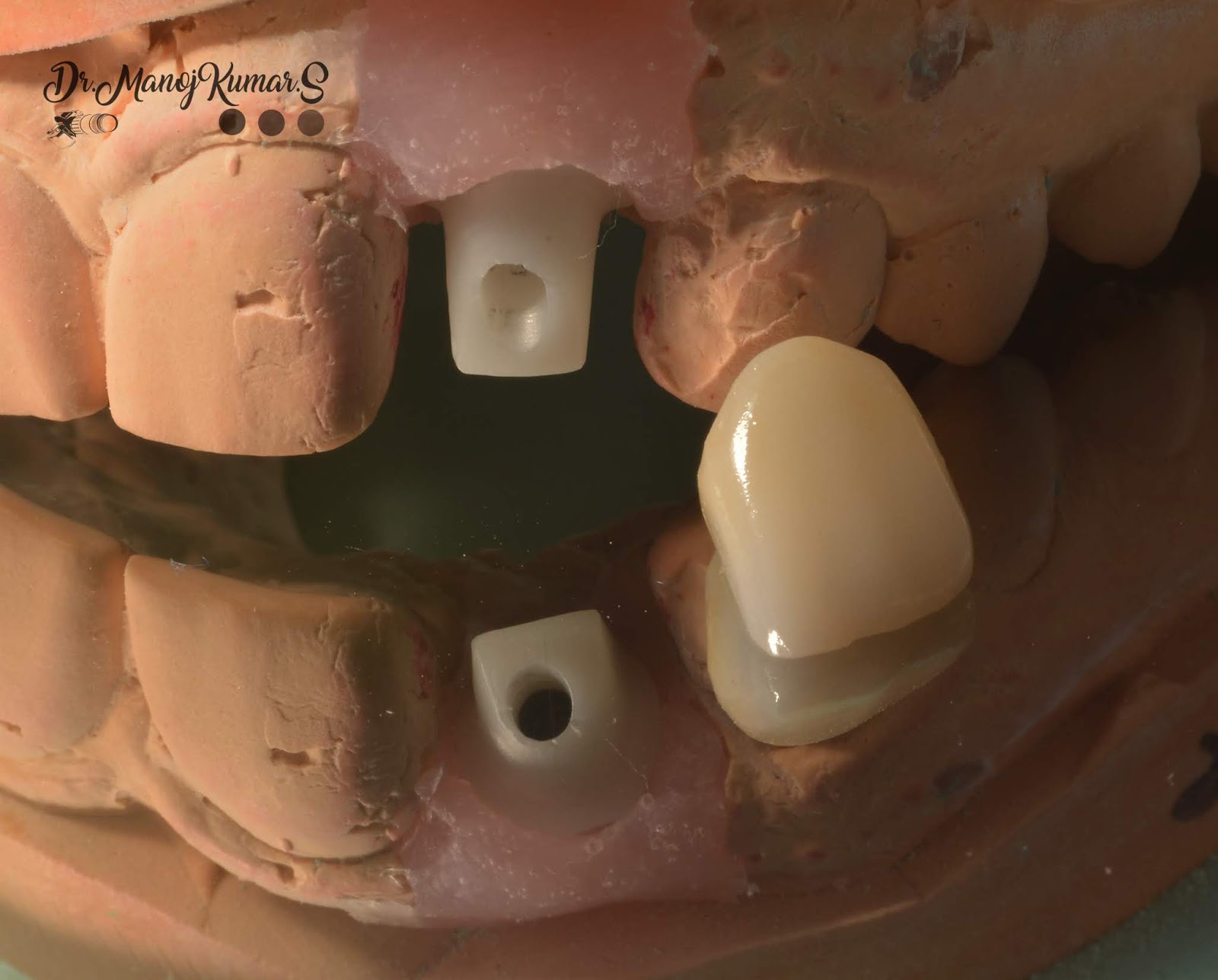 Case 1: Achieving the desired emergence profile - IMPLANT ESTHETICS