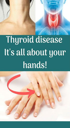 Do you have hypothyroidism? Look at your hands - Health and Tips