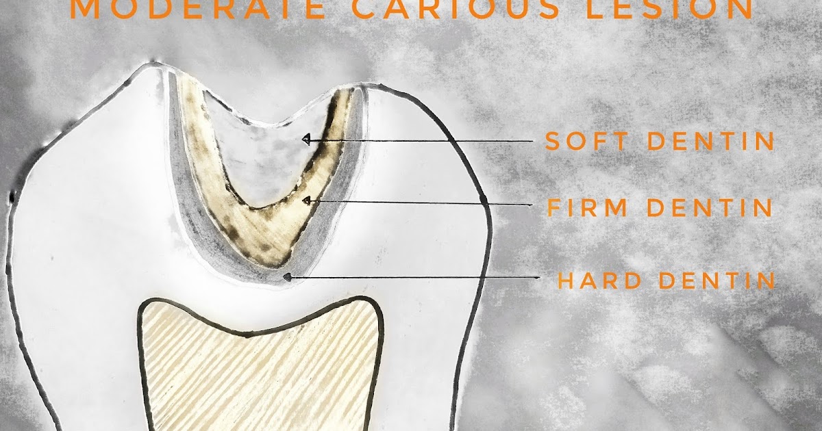 All about teeth!: Selective Caries Removal Protocol