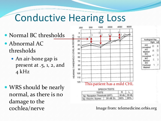 HEARING LOSS , AUDIOGRAM INTERPRETATION