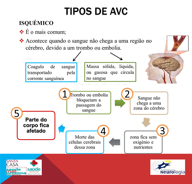 Saúde Mais Próxima: Tipos de AVC: Isquémico