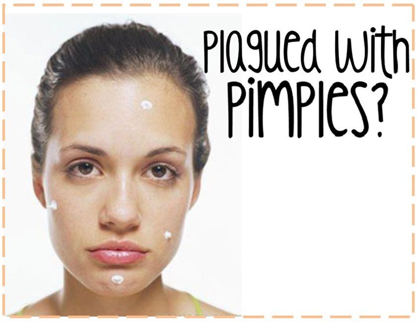 How To Cure Underground Pimples : Use Azelex Cream (azleaic Acid) For ...