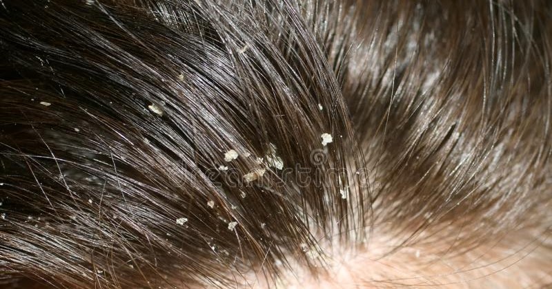 Causes of Dandruff, symptoms and effective natural remedies