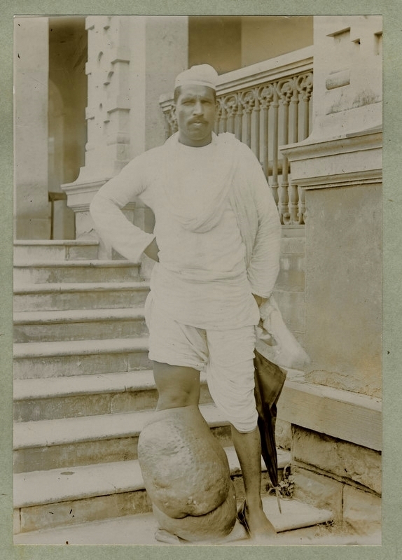 Man With Abnormal Growth in Leg - 1890's - Old Indian Photos