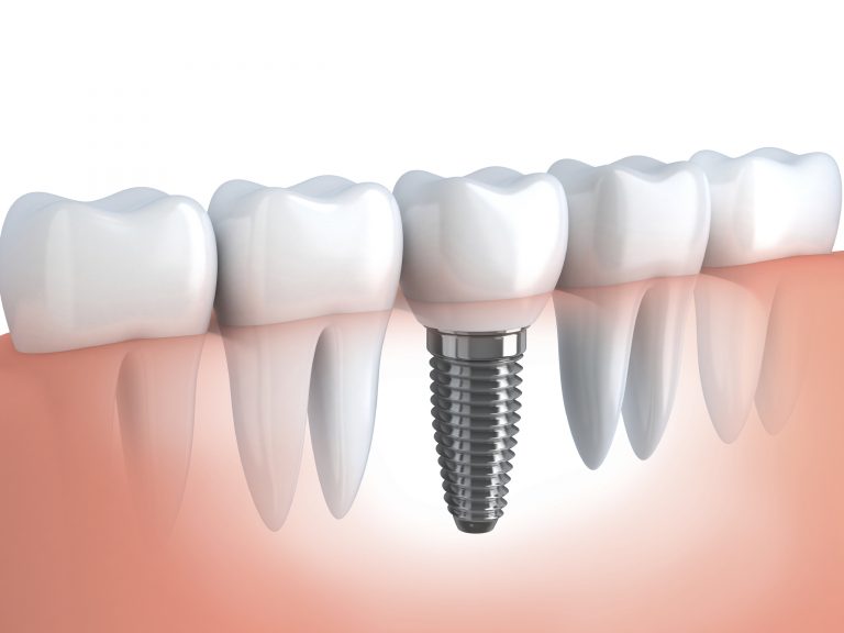 Dental Implant in Jamnagar ~ Dr. Bharat Katarmal Dental & Implant Clinic