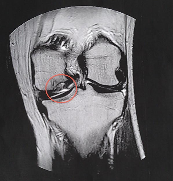 OT With a Bad Knee: Osteochondritis Dissecans (OCD of the Knee)