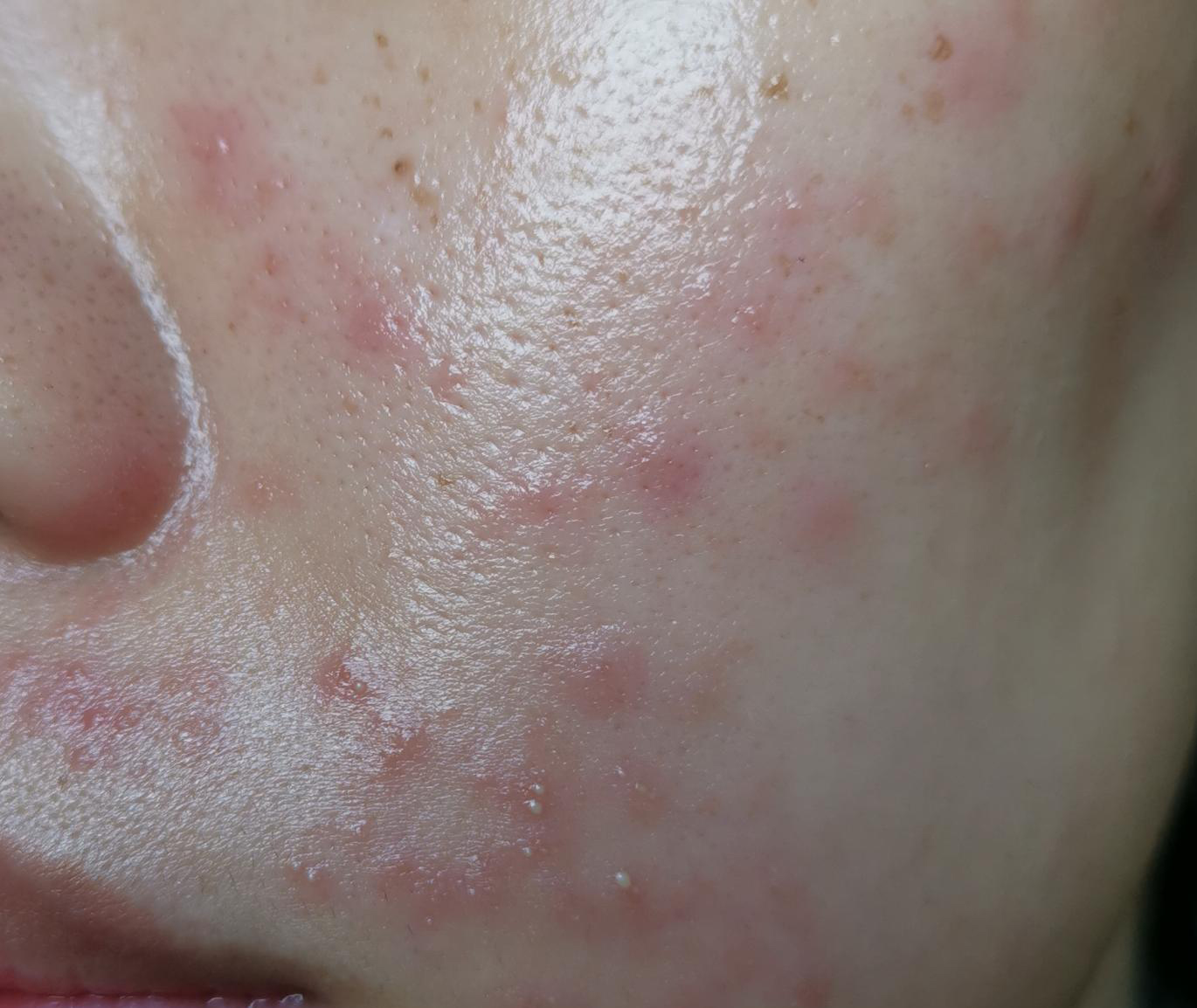 Live life to the fullest!: Active acne bumps after microneedling facial ...