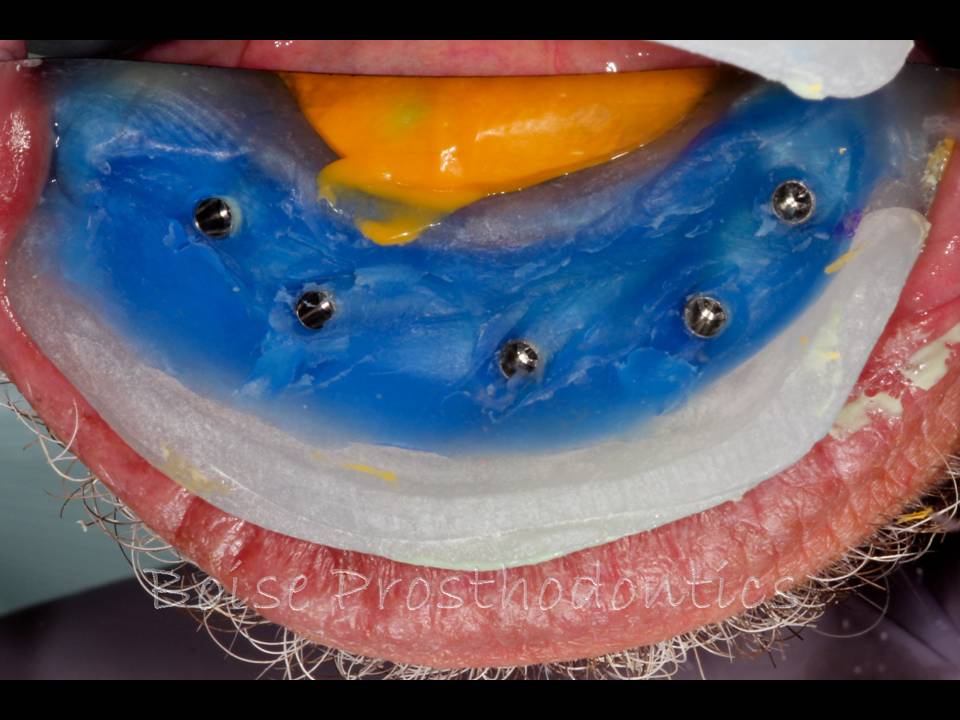 Boise Idaho Prosthodontics: Picture Sequence of Maxillary Complete ...