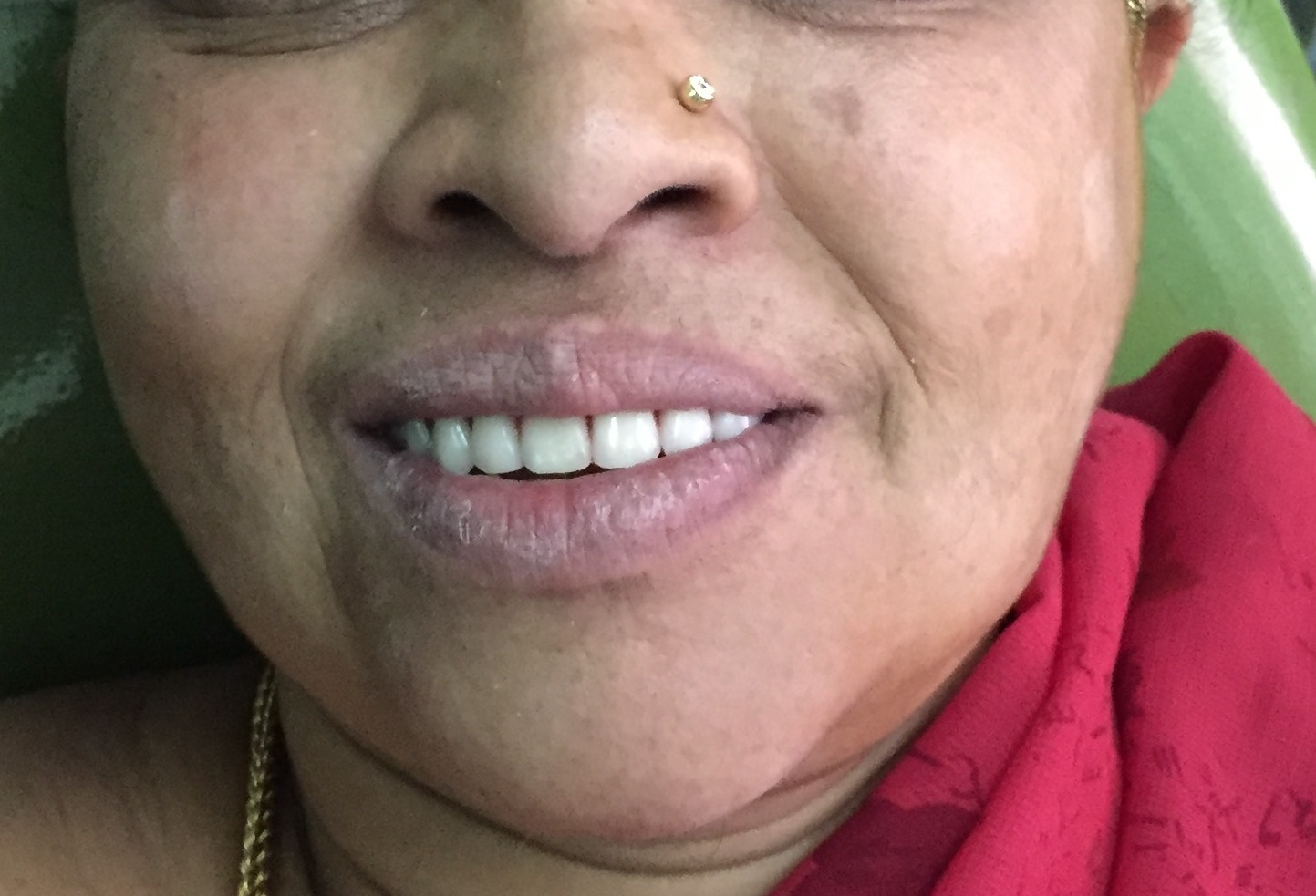 IHDE Dental Implants: Missing teeth, unable to chew, bad facial ...