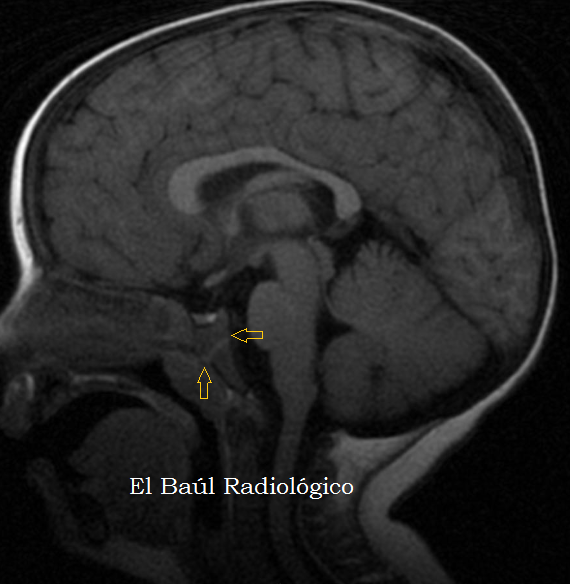 El Baúl Radiológico: SINCONDROSIS ESFENOBASILAR. (Sphenobasilar ...