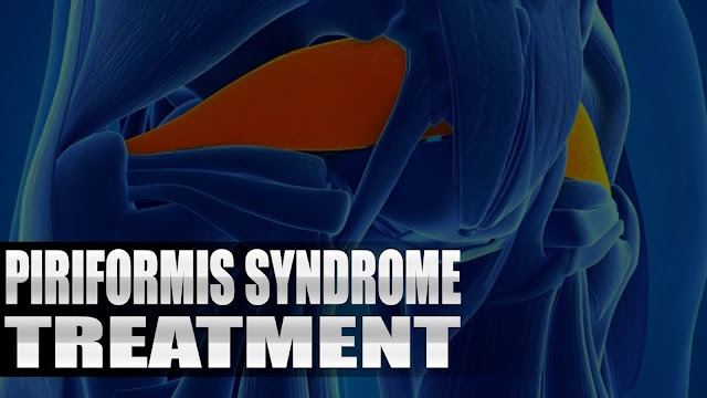 Piriformis Syndrome Treatment Chiropractor | El Paso, TX. | Video