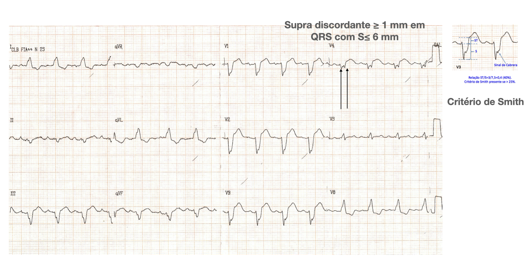 Blog de Eletrocardiografia: ATUALIZAÇÃO: ALGORITMO DE BARCELONA PARA O ...