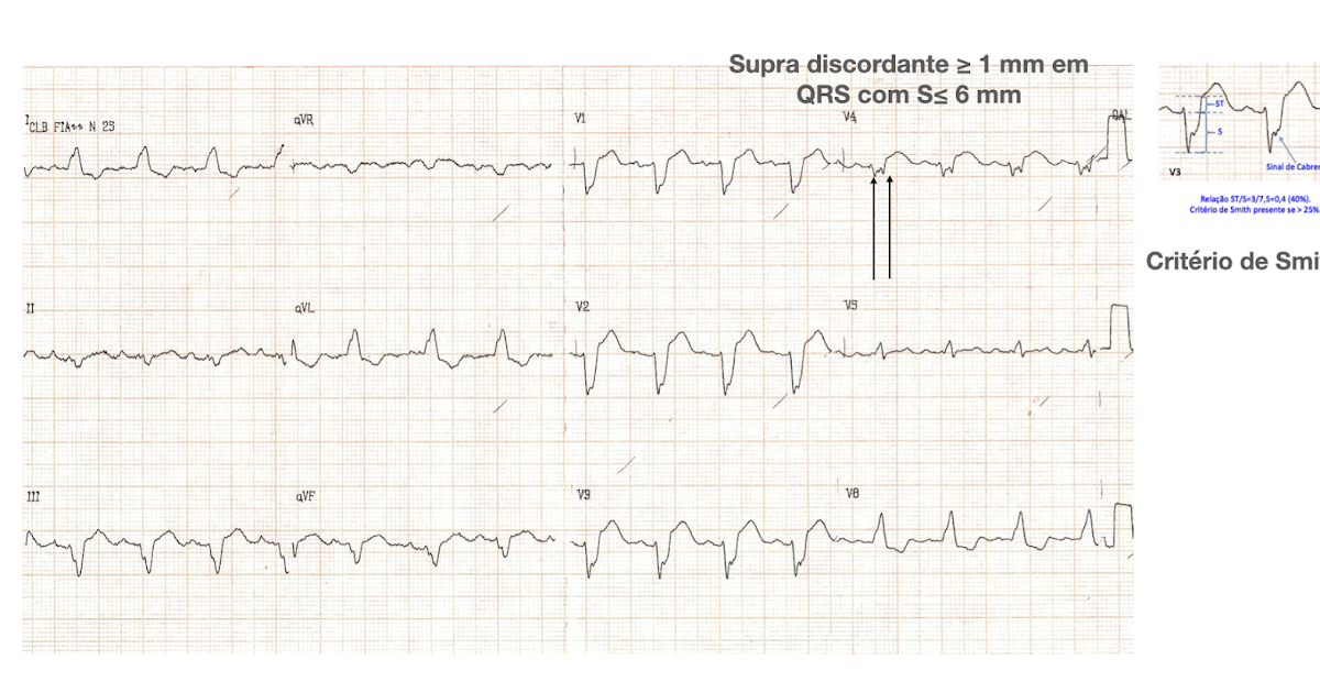 Blog de Eletrocardiografia: ATUALIZAÇÃO: ALGORITMO DE BARCELONA PARA O ...