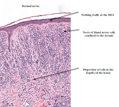 Dermpath Made Simple - Neoplastic: Benign Nevi