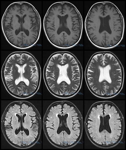Radiology Archives: Cavum Vergae