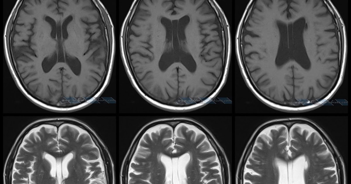 Radiology Archives: Cavum Vergae