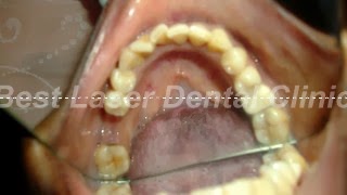 » missing premolar replaced with dental implants