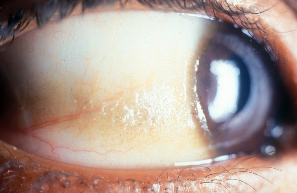 Vitamin A deficiency, Xerophthalmia, Grading and Treatment - Eye Health ...